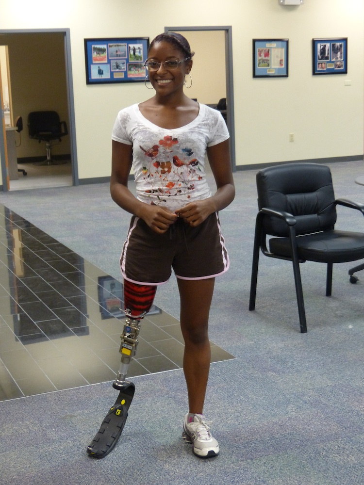Carla’s New AK prosthetic running leg, 11/5/2012 – Prosthetic ...