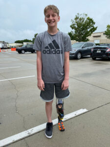 Rotationplasty – Prosthetic & Orthotic Associates