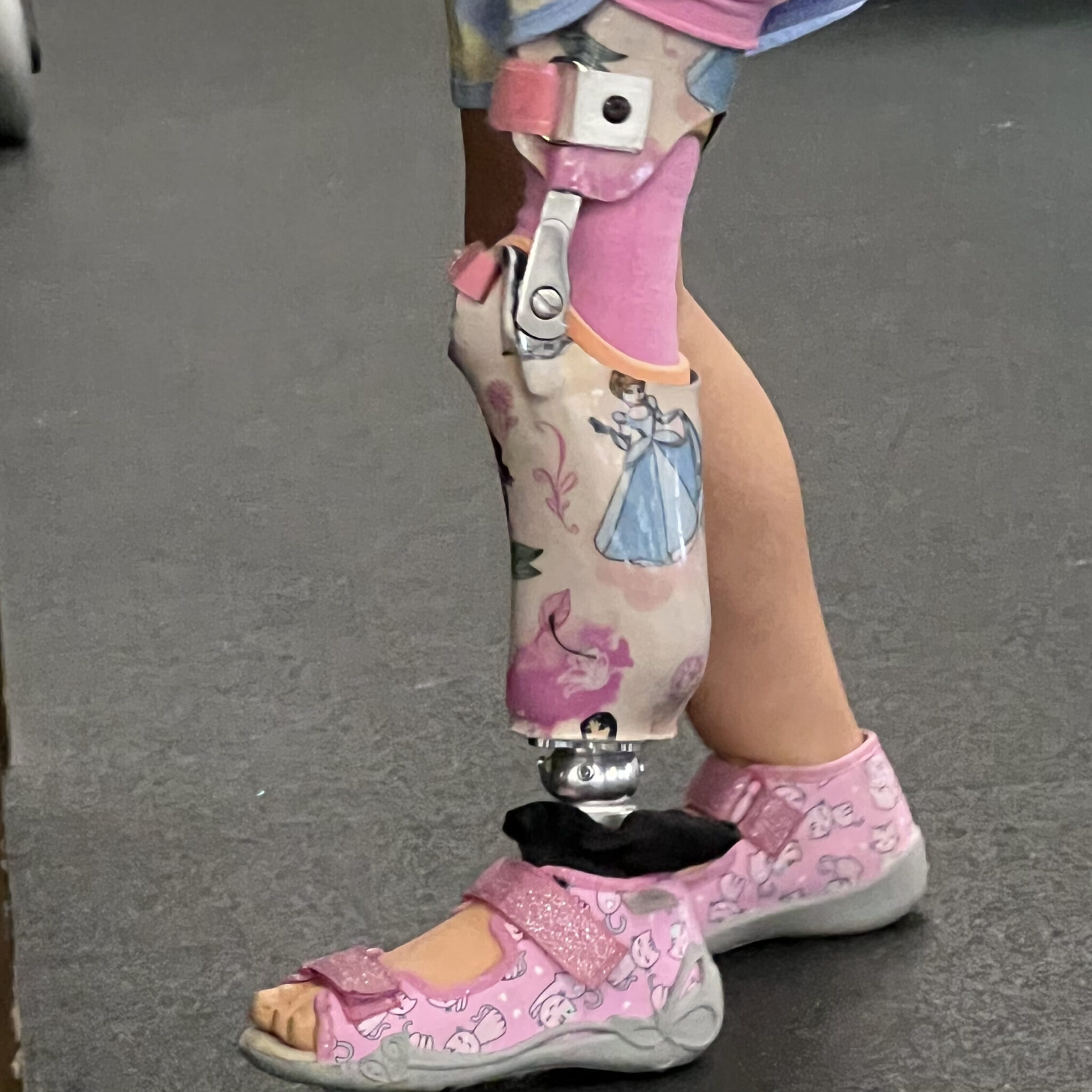 Rotationplasty – Prosthetic & Orthotic Associates